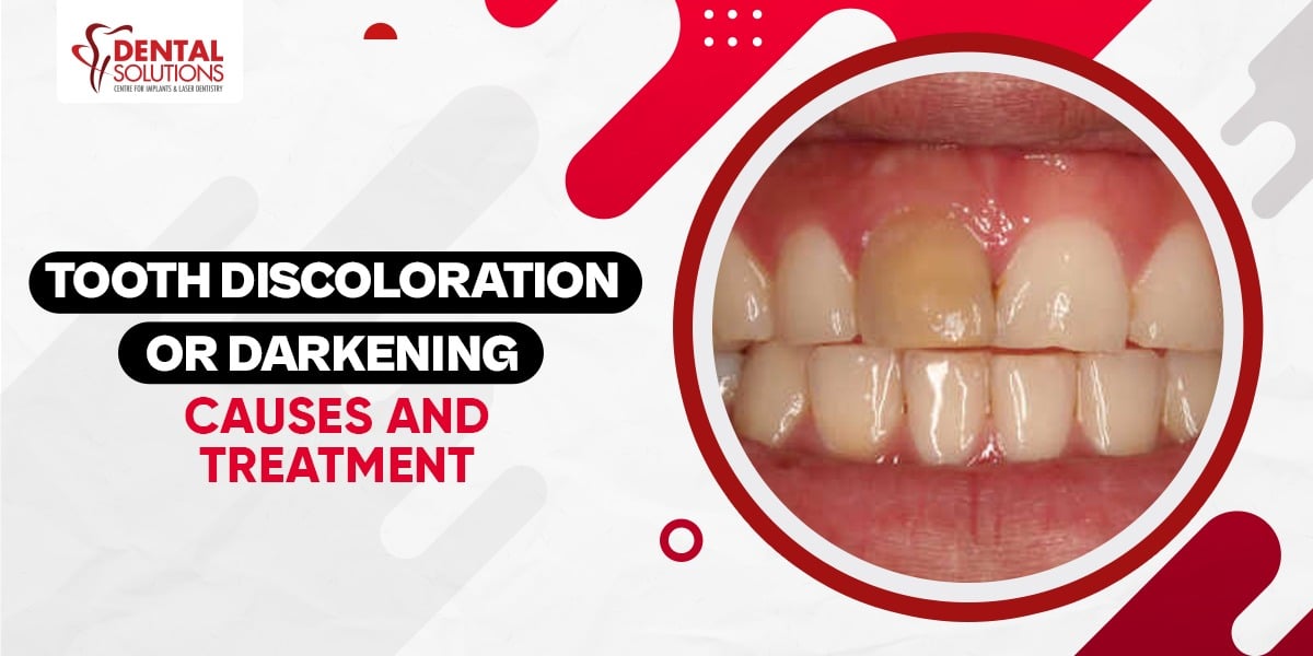 Tooth Discoloration Fix Uneven Teeth Color And Discoloration Of Teeth