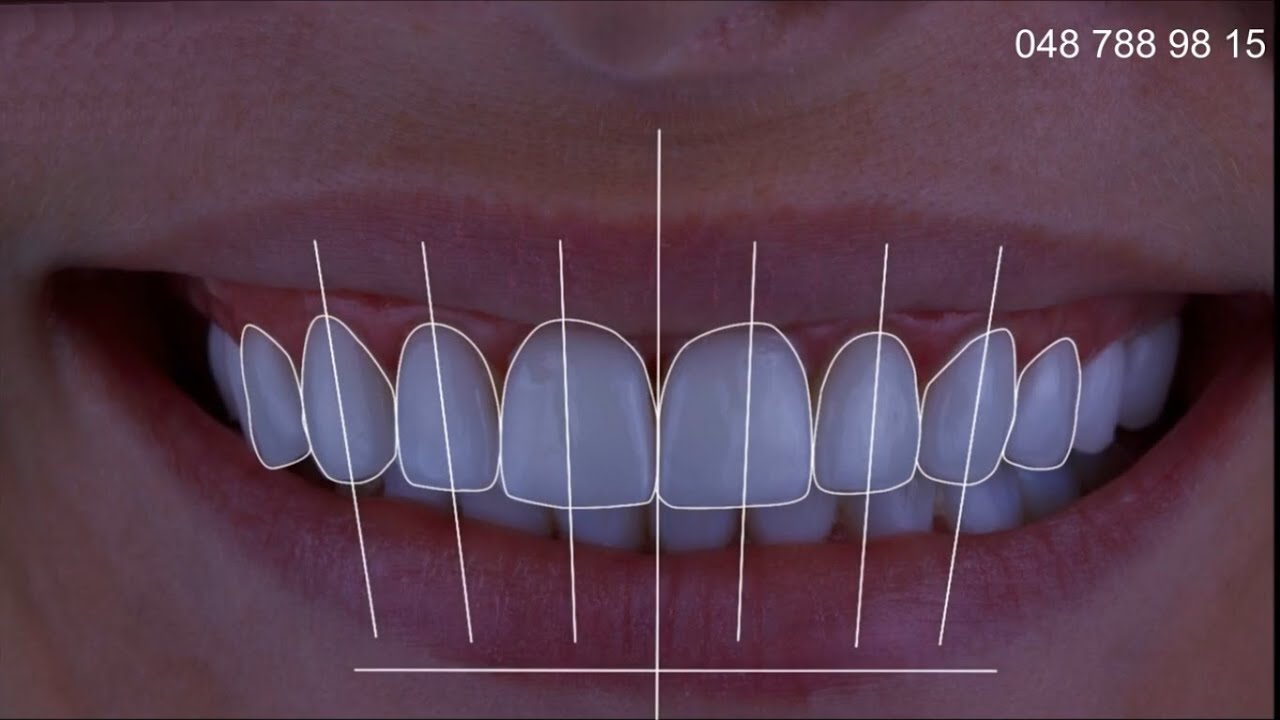 Digital Smile Design 1 - Best Dental Clinic In Bangalore Indiranagar ...