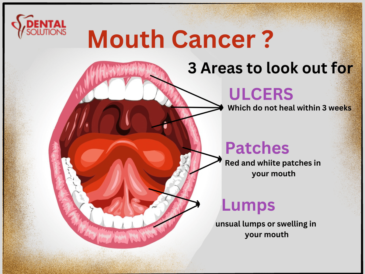 Mouth Cancer- Early Detection Can Save Life - Best Dental Clinic In ...